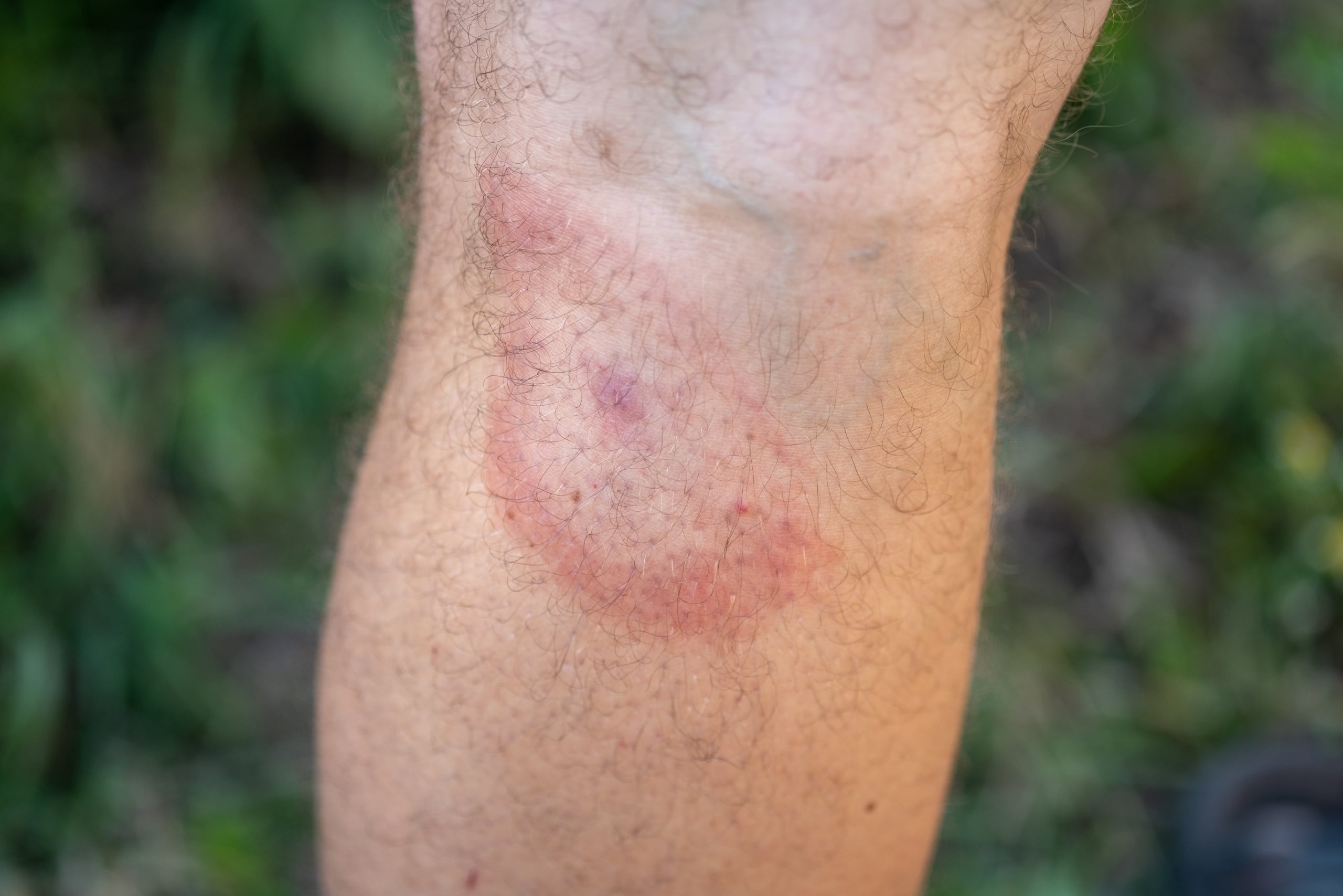 Bite Rash Gallery – Tick Science Alliance AU